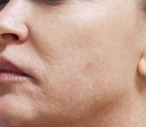 DermaSweep® Treatment Nashville - Curcio Dermatology