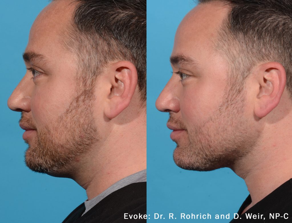 Customizable Facial and Neck Remodeling - Curcio Dermatology