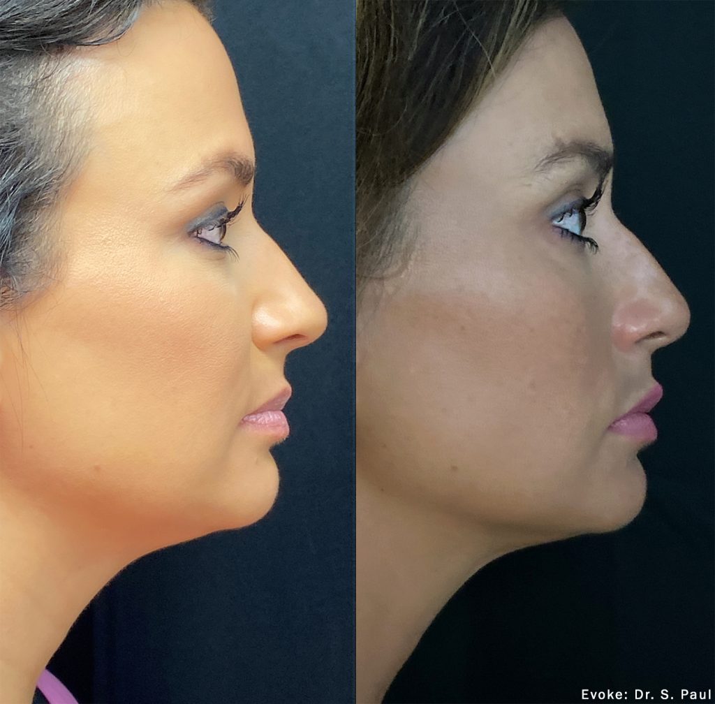 Customizable Facial and Neck Remodeling - Curcio Dermatology