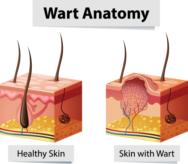 Wart Removal in Nashville Tennessee - Curcio Dermatology